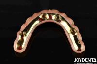 China Comfortable To Wear Ti-Bar Restores Chewing Function Essential Ti-Bar Zirconia Hybrid Bridge For B2B Transactions for sale