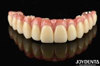 China Low Density Light Weight Comfortable To Wear Titanium Malong Hybrid Bridge For Long-Lasting Performance for sale