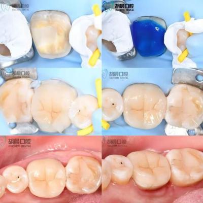 China Experience The Precision Of Dental Inlay Affordable And White For Perfect Fit for sale