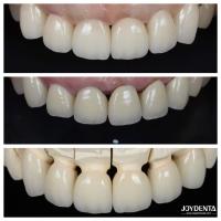 China Excellent Biocompatibility Dental Porcelain Veneers No Need For Preparation Process for sale