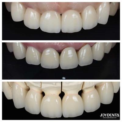 China Excellent Biocompatibility Dental Porcelain Veneers No Need For Preparation Process for sale