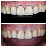 China Comfortable Zirconia Dental Bridges Lightweight Natural Color Transitions For Optimal Patient Experience for sale