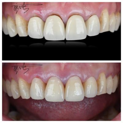 China Comfortable Zirconia Dental Bridges Lightweight Natural Color Transitions For Optimal Patient Experience for sale