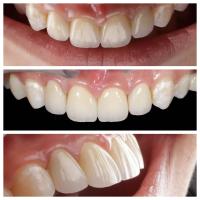 China Anterior Tooth Indication Dental Veneers With 0.5mm Thickness And Perfect Permeability for sale