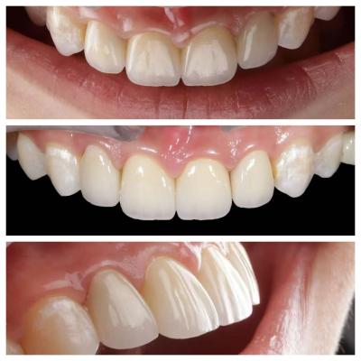 China Anterior Tooth Indication Dental Veneers With 0.5mm Thickness And Perfect Permeability for sale
