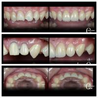 China Nature Dental Veneers For  Natural And Beautiful Smile for sale