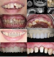 China Biocompatibility Safe Zirconia Dental Crowns For Long-term And Implant-supported Restorations for sale