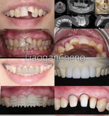 China Biocompatibility Safe Zirconia Dental Crowns For Long-term And Implant-supported Restorations for sale