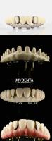China Dental Aesthetic Titanium Malong Hybrid Bridge Ultimate Solution For Dental Restorations for sale