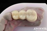 China Flexural Strength 90-100 MPa Ensures Strong And Stable Temporary Restorations PMMA for sale