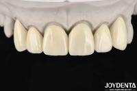 China 6.0-6.1 G/cm3 Density Layered Zirconia For High Translucency In CAD / CAM Milling for sale