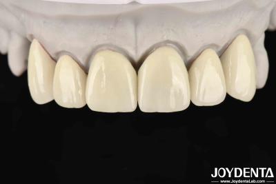 China 6.0-6.1 G/cm3 Density Layered Zirconia For High Translucency In CAD / CAM Milling for sale