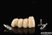 China Customizable Implant Crown And Bridge In Porcelain Precision For Perfect Function for sale