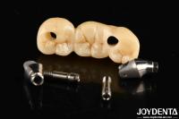 China Strong Implant Crown And Bridge Perfect Solution For Aesthetically Pleasing Esthetics for sale