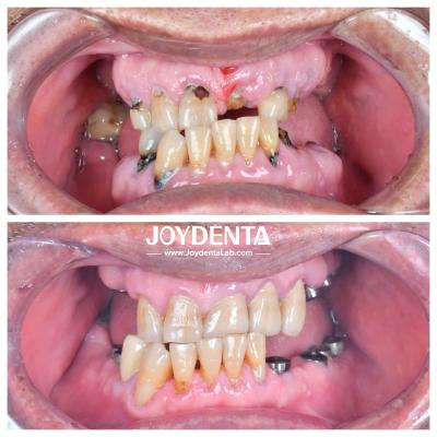 China Resistant To Wear And Deformation Zirconia Dental Crowns Durable and Suitable For Posterior And Anterior Restorations for sale