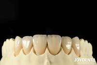 China Bionic Development Leaves And Distinct Layers Of Zirconia All-Ceramic for sale