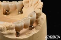 China Zirconia Implants Perfect Match With Natural Teeth Zero Allergy Risk for sale