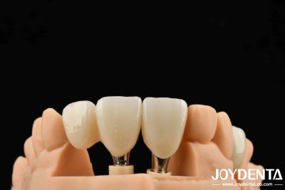 China Premium Zirconia Implants for Superior Aesthetic Results Allergy-Safe Solutions and Precision Strength for sale