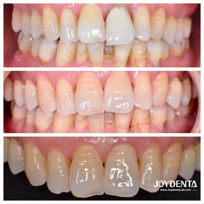 China Premium Zirconium Crowns | Global Dental Lab Outsourcing | JOY Dental Lab for sale