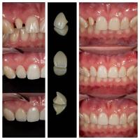 China Zirconia Dental Crowns Fabrication Lab | Precision Crown Outsourcing - Joydentalab for sale