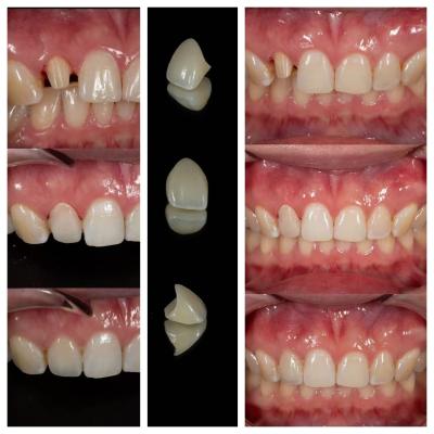 China Zirconia Dental Crowns Fabrication Lab | Precision Crown Outsourcing - Joydentalab for sale