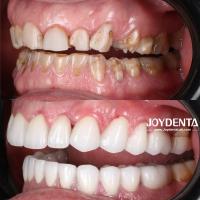 China Premium Zirconia Dental Crown Solutions | JOY Dental Lab for sale