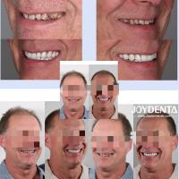 China Zirconia dentures that imitate natural teeth for sale