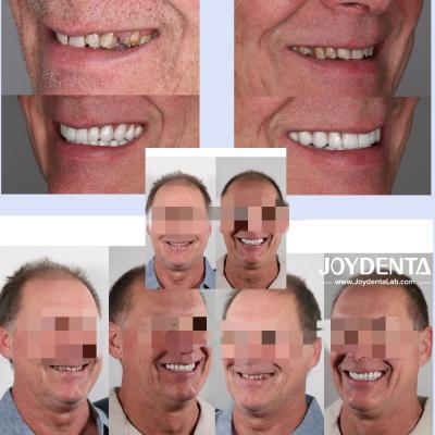 China Zirconia dentures that imitate natural teeth for sale
