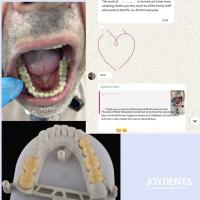 China Zirconia dentures that imitate natural teeth for sale