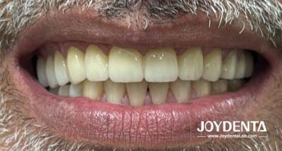 China Zirconia dentures that imitate natural teeth for sale