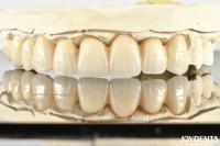China Revolutionize Aesthetics & Strength: Introducing Our Multi-Layered Chromatic Zirconia Bridge for sale