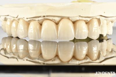 China Revolutionize Aesthetics & Strength: Introducing Our Multi-Layered Chromatic Zirconia Bridge for sale