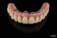 China Redefining Full Arch Prosthetics: Unmatched Fit and Function with Our Ti-Base Complete Dentures for sale