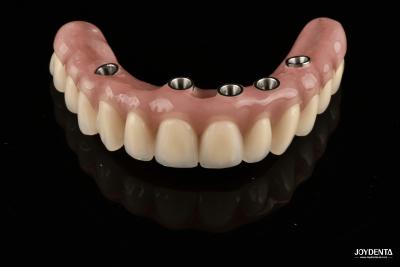 China Redefining Full Arch Prosthetics: Unmatched Fit and Function with Our Ti-Base Complete Dentures for sale