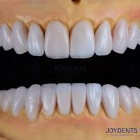 China Custom Crafted Emax Porcelain Veneers Smooth Texture Dental Restorations for sale