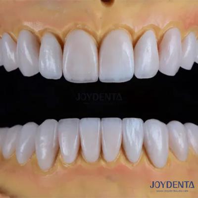 China Custom Crafted Emax Porcelain Veneers Smooth Texture Dental Restorations for sale