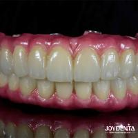 China Lightweight Dental Titanium Malong Hybrid Bridge Comfortable For Dental Restoration for sale
