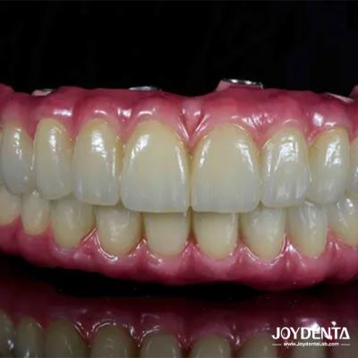 China Lightweight Dental Titanium Malong Hybrid Bridge Comfortable For Dental Restoration for sale