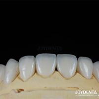 China Glossy Surface Texture Feldspathic Veneer Natural Looking Porcelain Veneer for sale