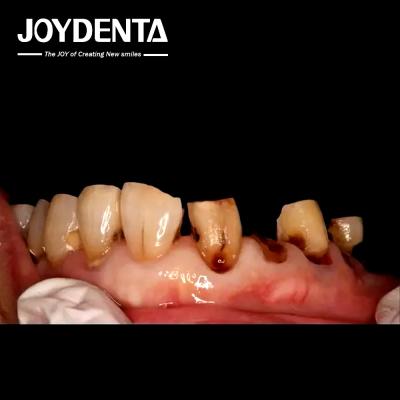 China Premium Zirconia Crowns for Global Dental Labs | JOY Dental Lab for sale