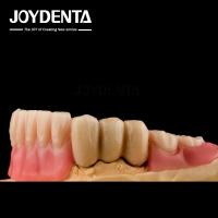 China Stainless Steel Prostheses Partial Dentures Attachments Polished Surface Ball Attachments for sale