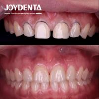 China Cosmetic Dentistry Dental Veneers Lab | Premium Porcelain & Composite Veneers Outsourcing - Joydentalab for sale