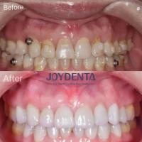China Dental Veneers for Missing Teeth | Global Premium Dental Lab Services for sale