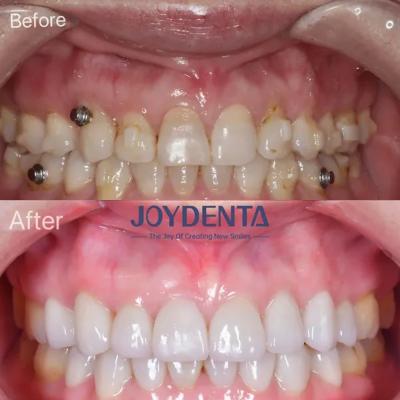 China Dental Veneers for Missing Teeth | Global Premium Dental Lab Services for sale