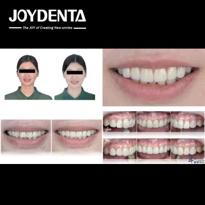China Joydentalab's popular products: Simulated aesthetic veneers for sale