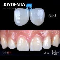 China Anterior Tooth Indication Dental Veneers With No Preparation Needed And No Discoloration for sale