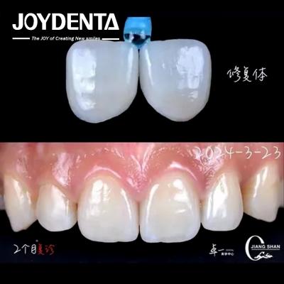 China Anterior Tooth Indication Dental Veneers With No Preparation Needed And No Discoloration for sale