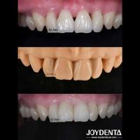 China Grassshopper Veneers The Perfect Solution For Natural Translucency Dental Veneers for sale