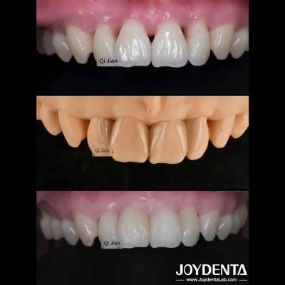 China Grassshopper Veneers The Perfect Solution For Natural Translucency Dental Veneers for sale