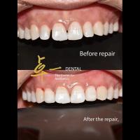 China Say Hello To A Flawless Smile With Cosmetic Dental Veneers No Discoloration No Preparation for sale